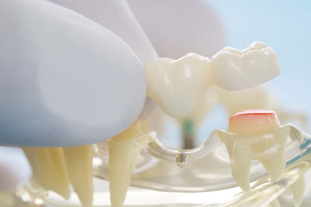How Do You Clean & Floss a Dental Bridge? | Aliso Smiles