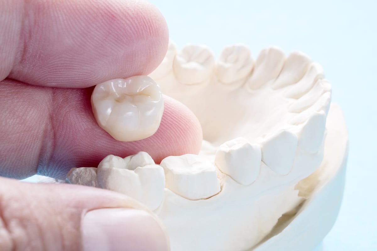 What Are the Benefits of CEREC Crowns? | Aliso Viejo, CA